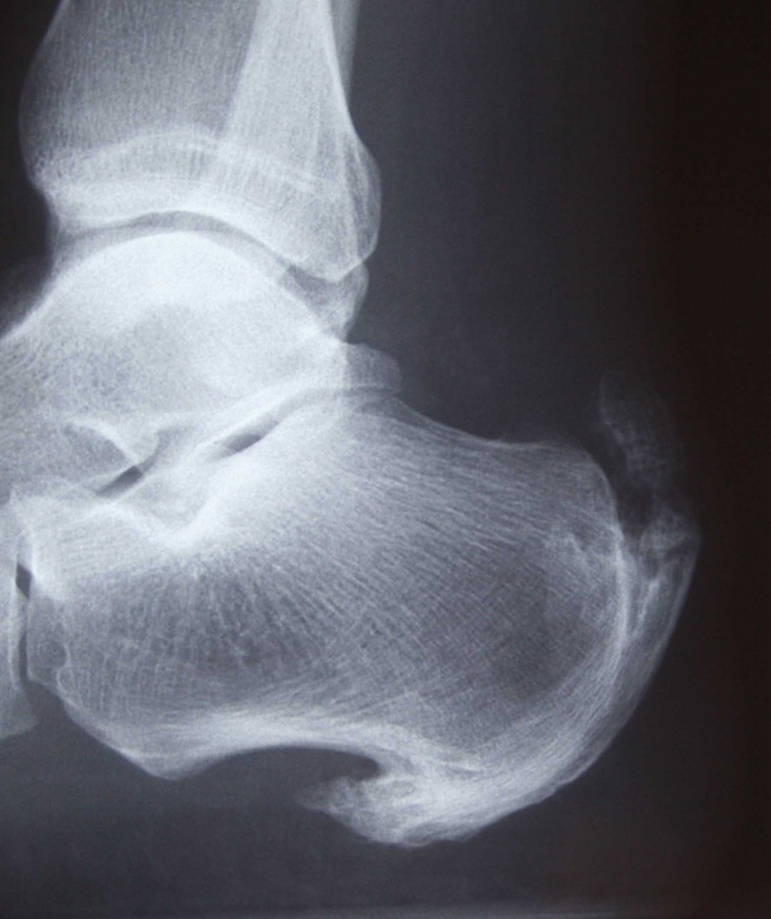 Foot and Ankle Surgery | The Tagoe Clinic