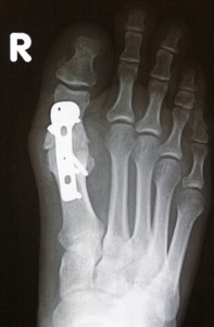 Hallux Limitus | The Tagoe Clinic